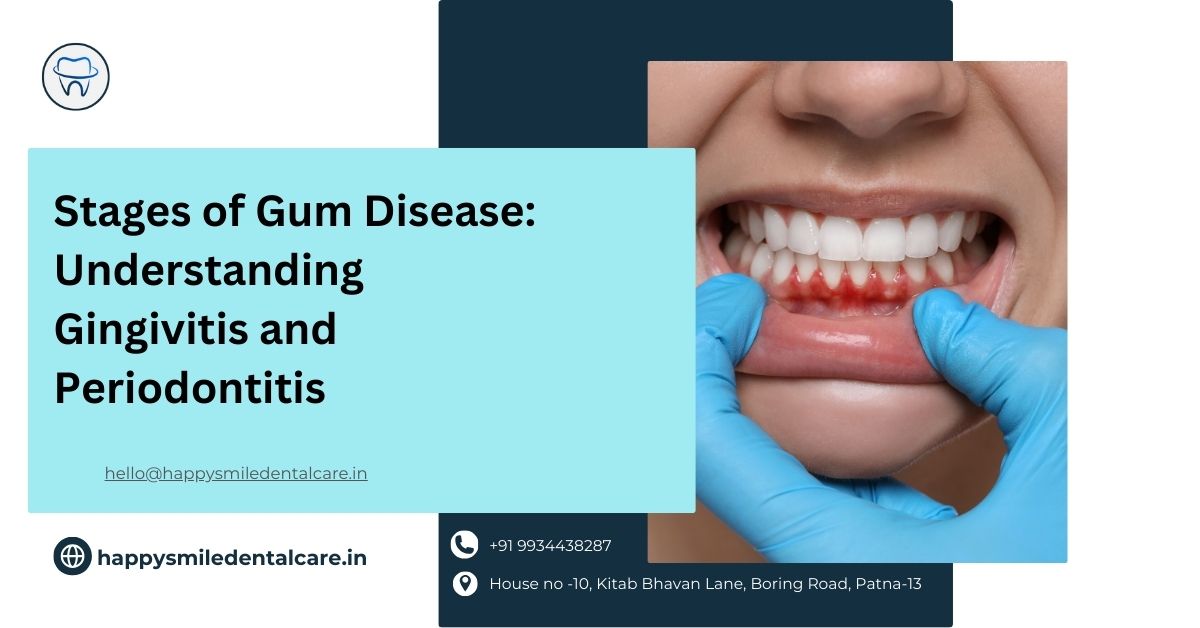 Stages of Gum Disease: Understanding Gingivitis and Periodontitis ...